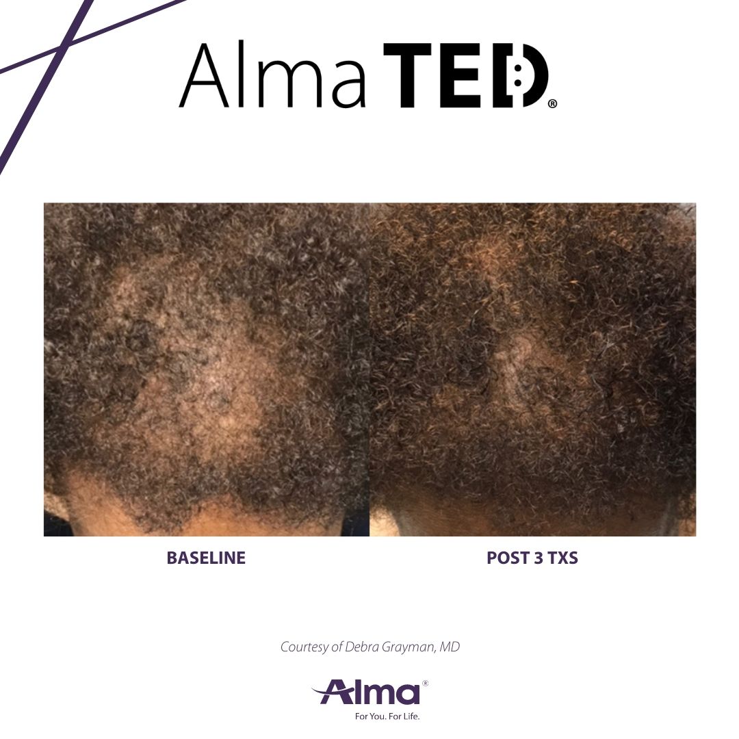 Hair Loss Treatment | Alma TED | Vibrant Med Spa